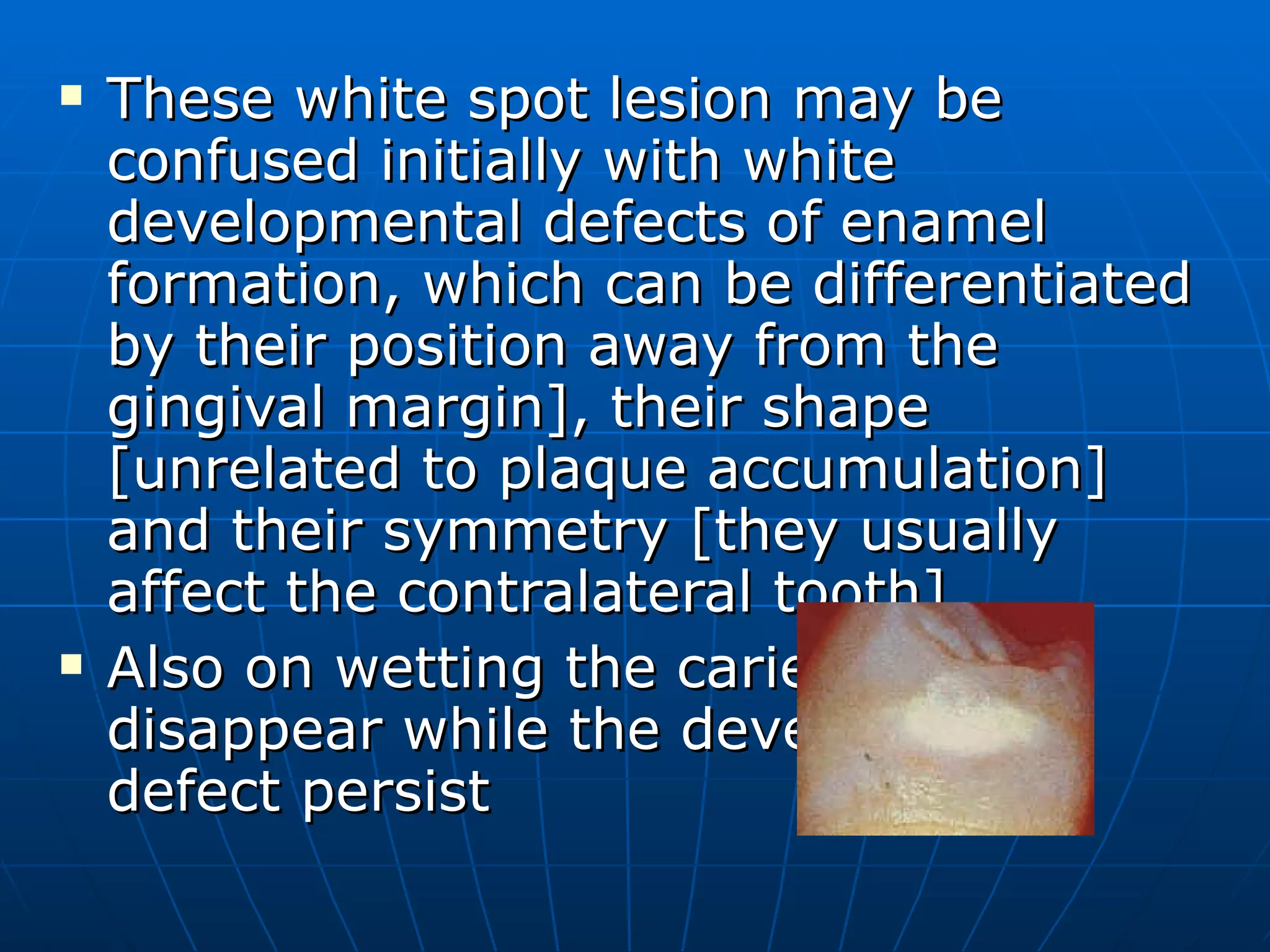 Classification Of Dental Caries | PPT