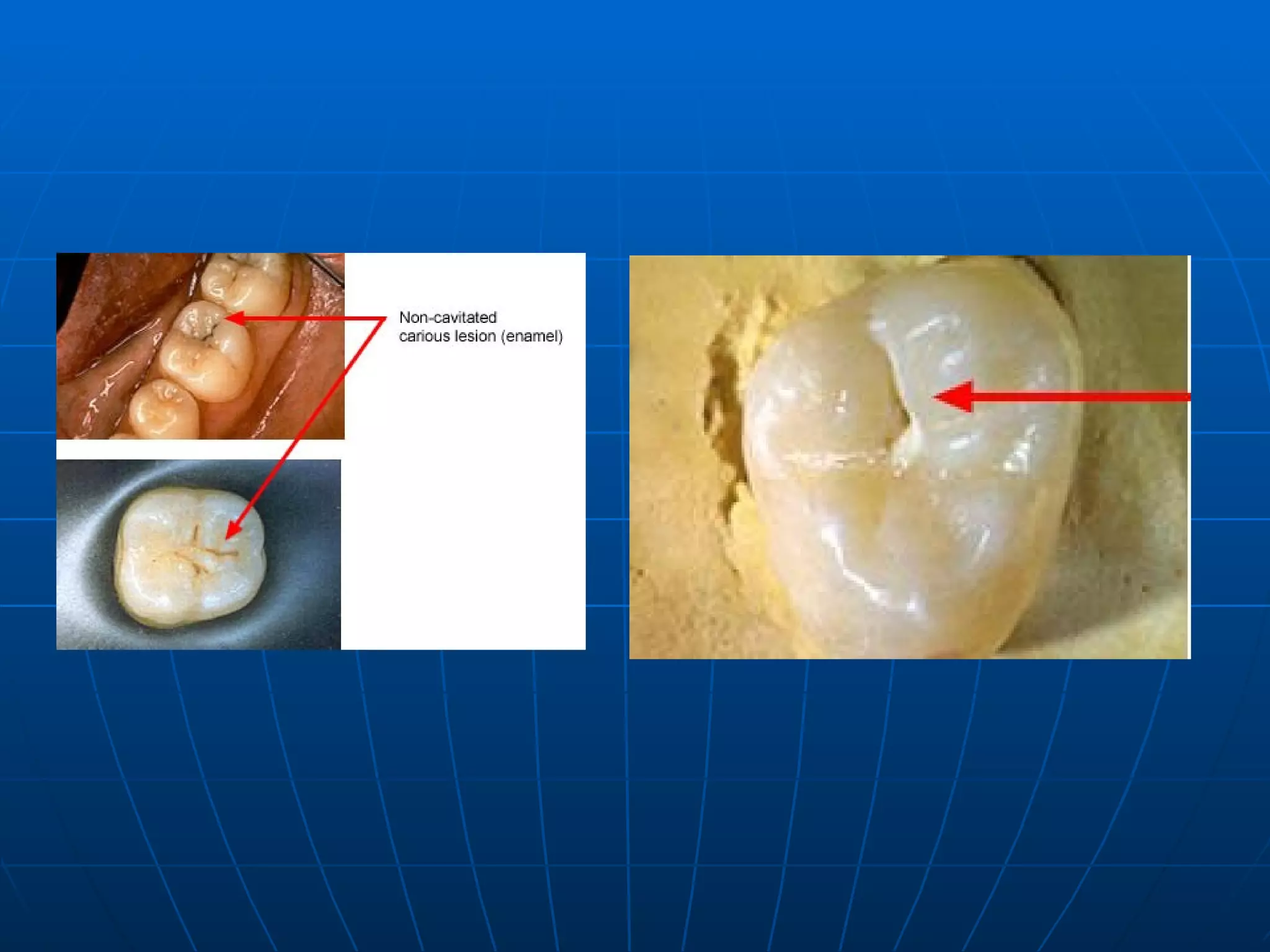 Classification Of Dental Caries Ppt