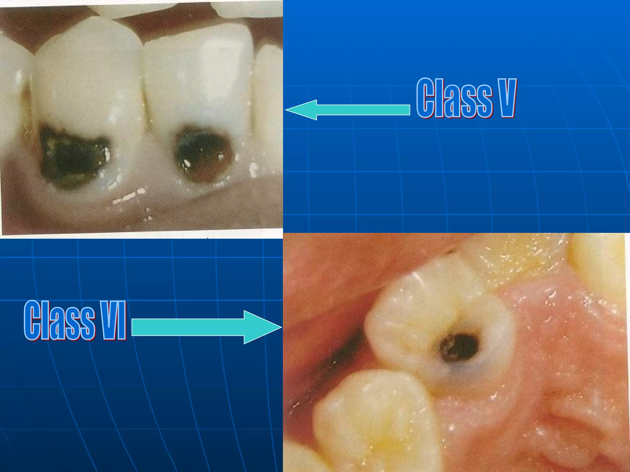 Classification Of Dental Caries | PPT