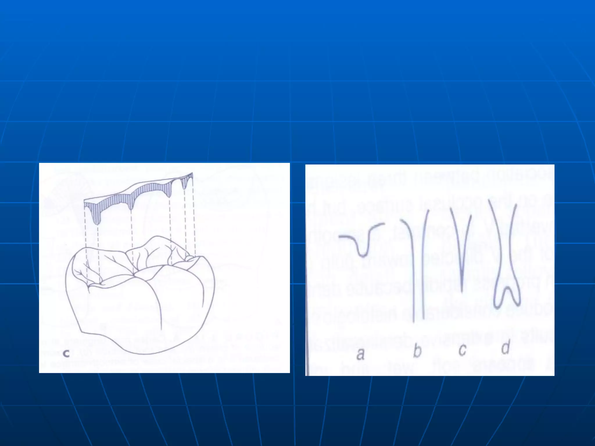 Classification Of Dental Caries | PPT