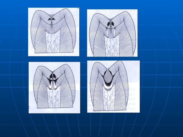 Classification Of Dental Caries | PPT