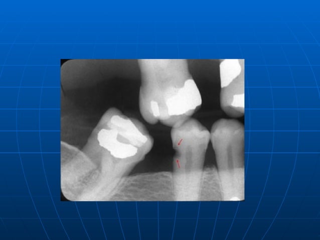 Classification Of Dental Caries | PPT