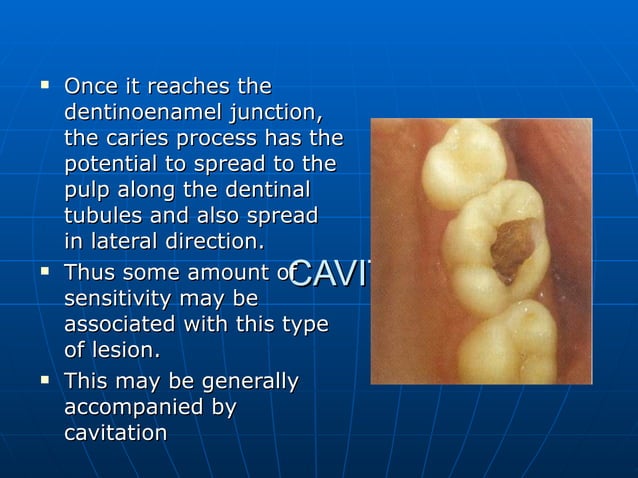 Classification Of Dental Caries | PPT