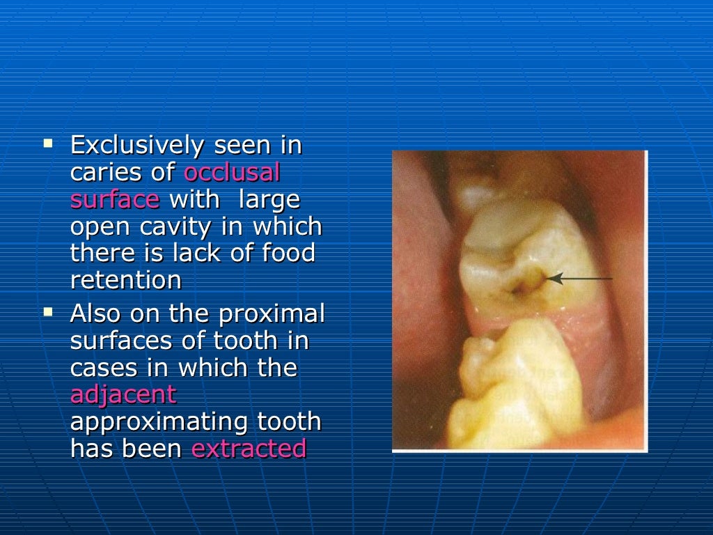 Classification Of Dental Caries