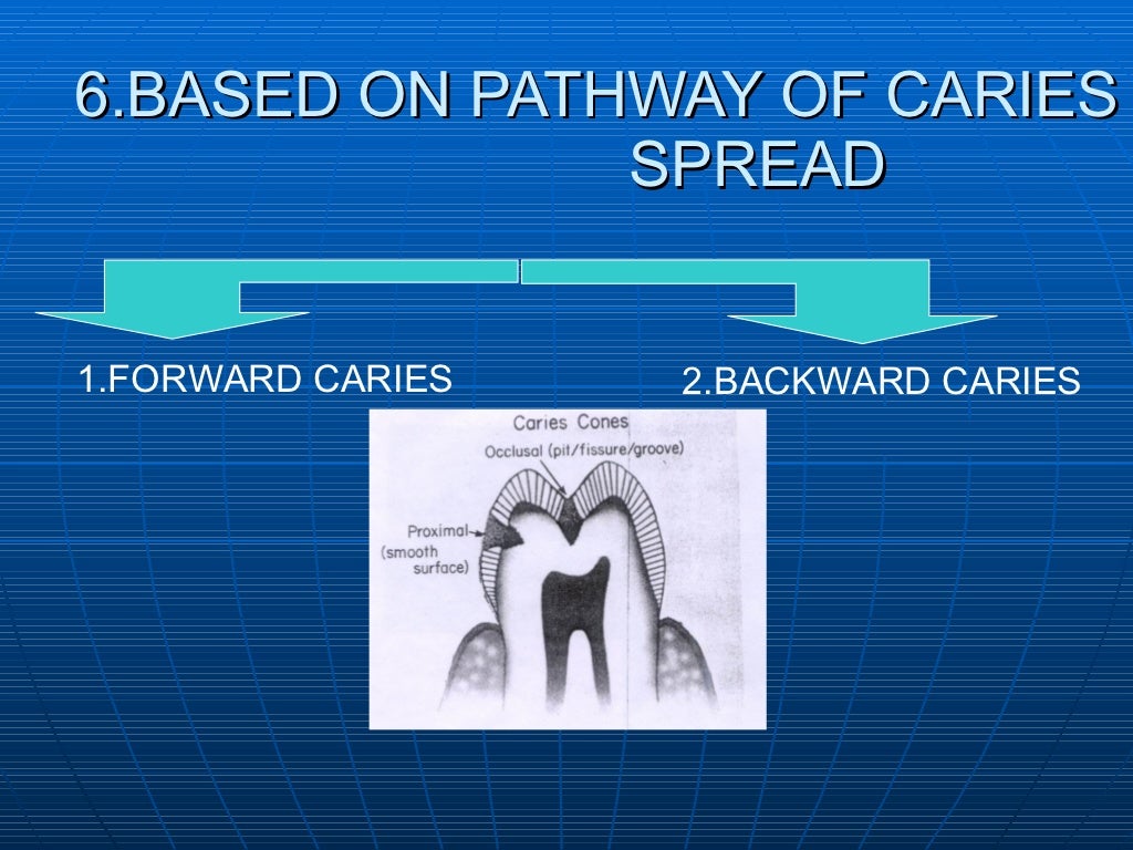 Classification Of Dental Caries