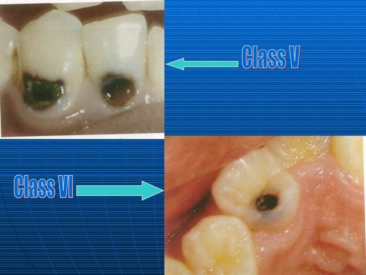 Classification Of Dental Caries
