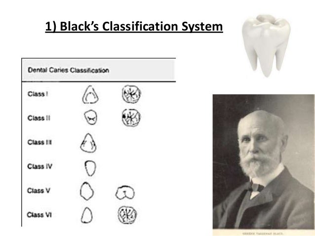 Icdas Caries Classification