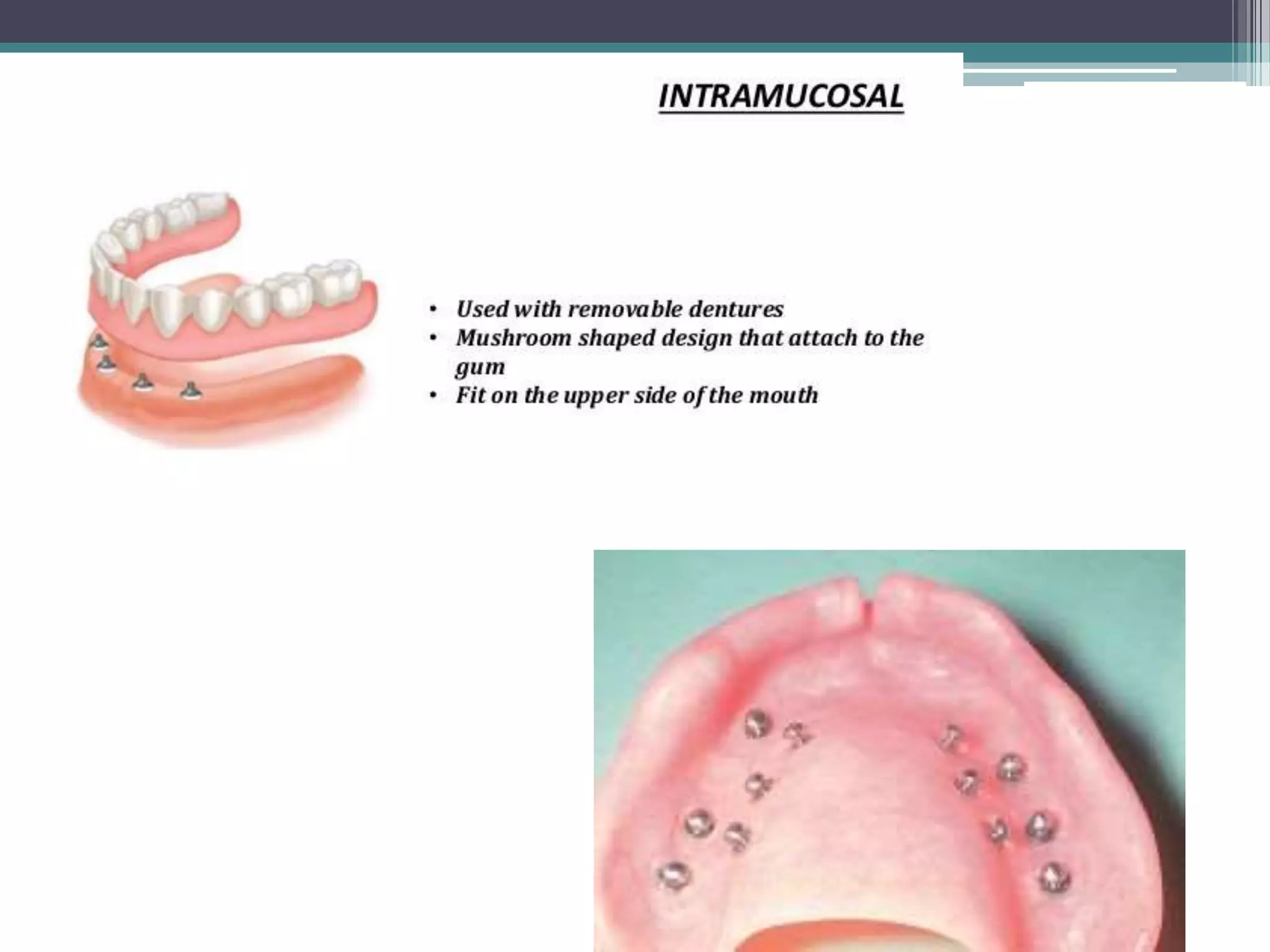 Classification of dental implant | PPTX