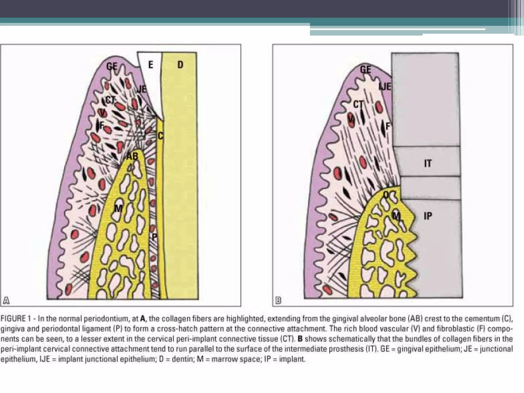 Classification of dental implant | PPTX