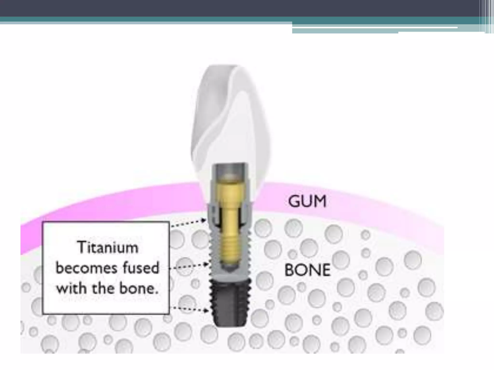 Classification of dental implant | PPTX
