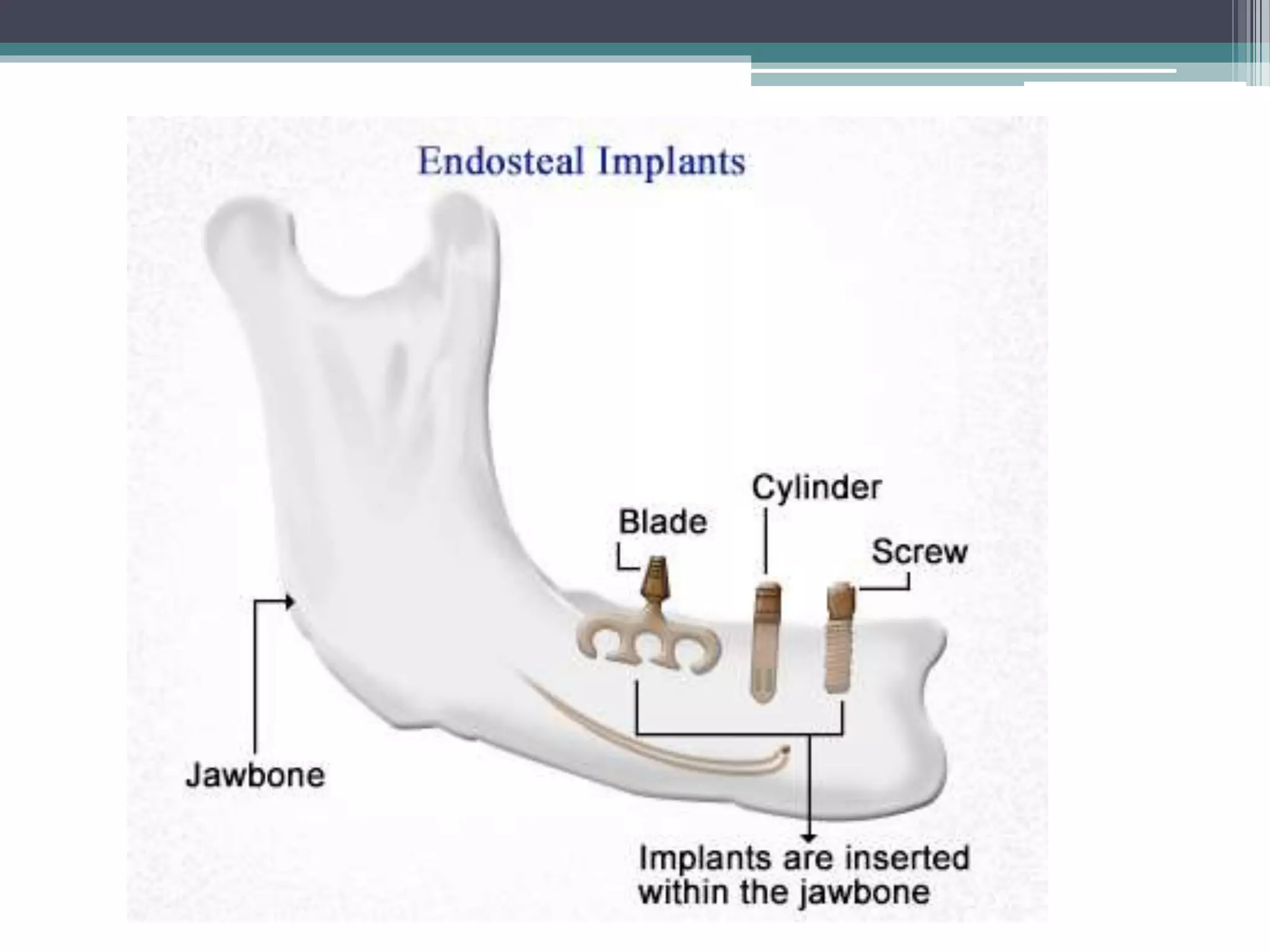 Classification of dental implant | PPTX