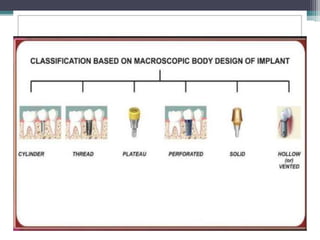 Classification of dental implant | PPTX