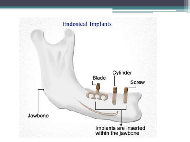 Classification of dental implant | PPTX | Dental Health | Diseases and ...