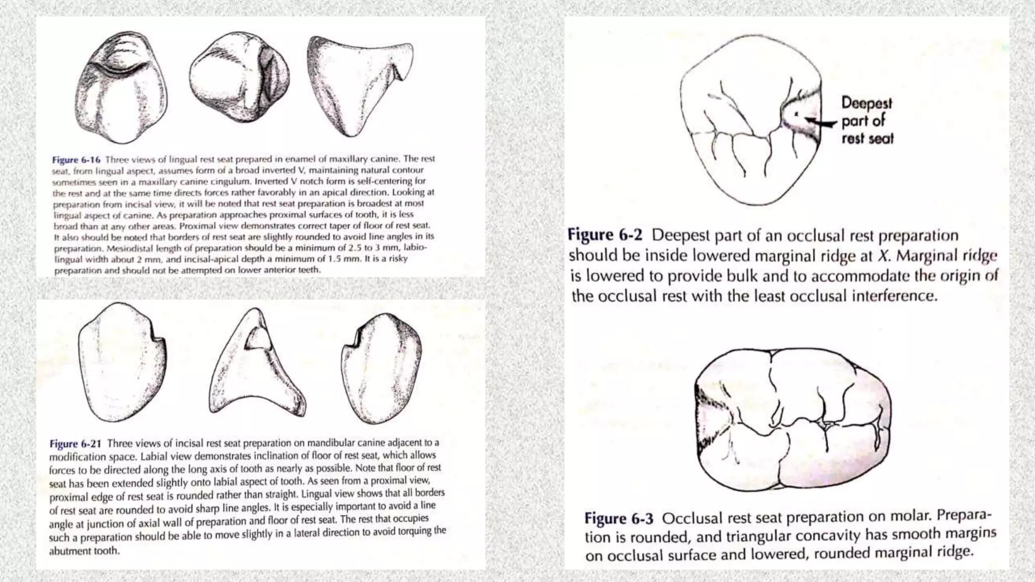 Classification of direct retainers,rests and rest seats | PPT