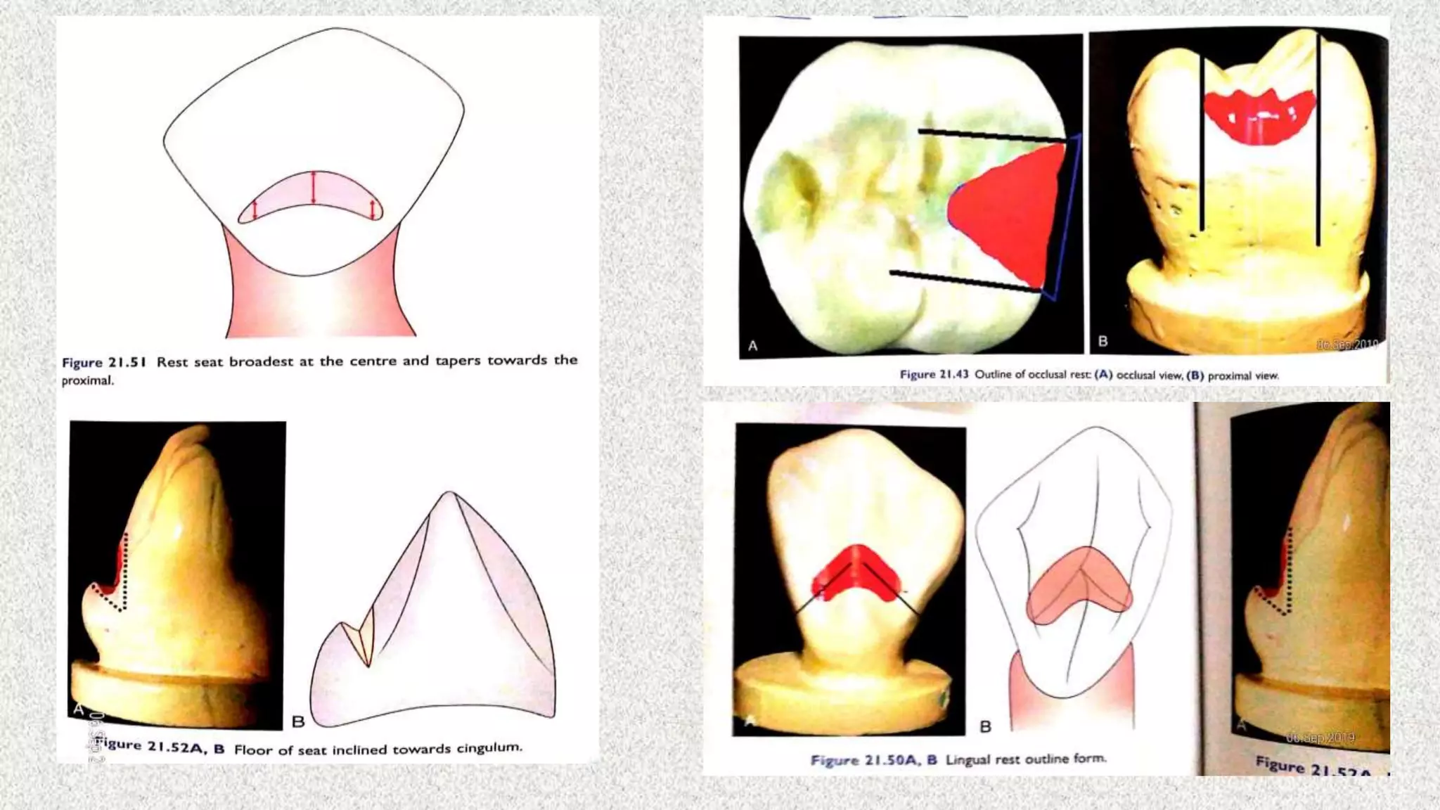 Classification of direct retainers,rests and rest seats | PPT