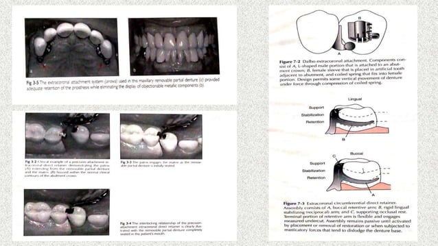Classification of direct retainers,rests and rest seats | PPT