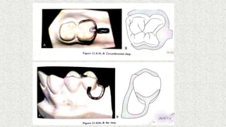 Classification of direct retainers,rests and rest seats | PPT