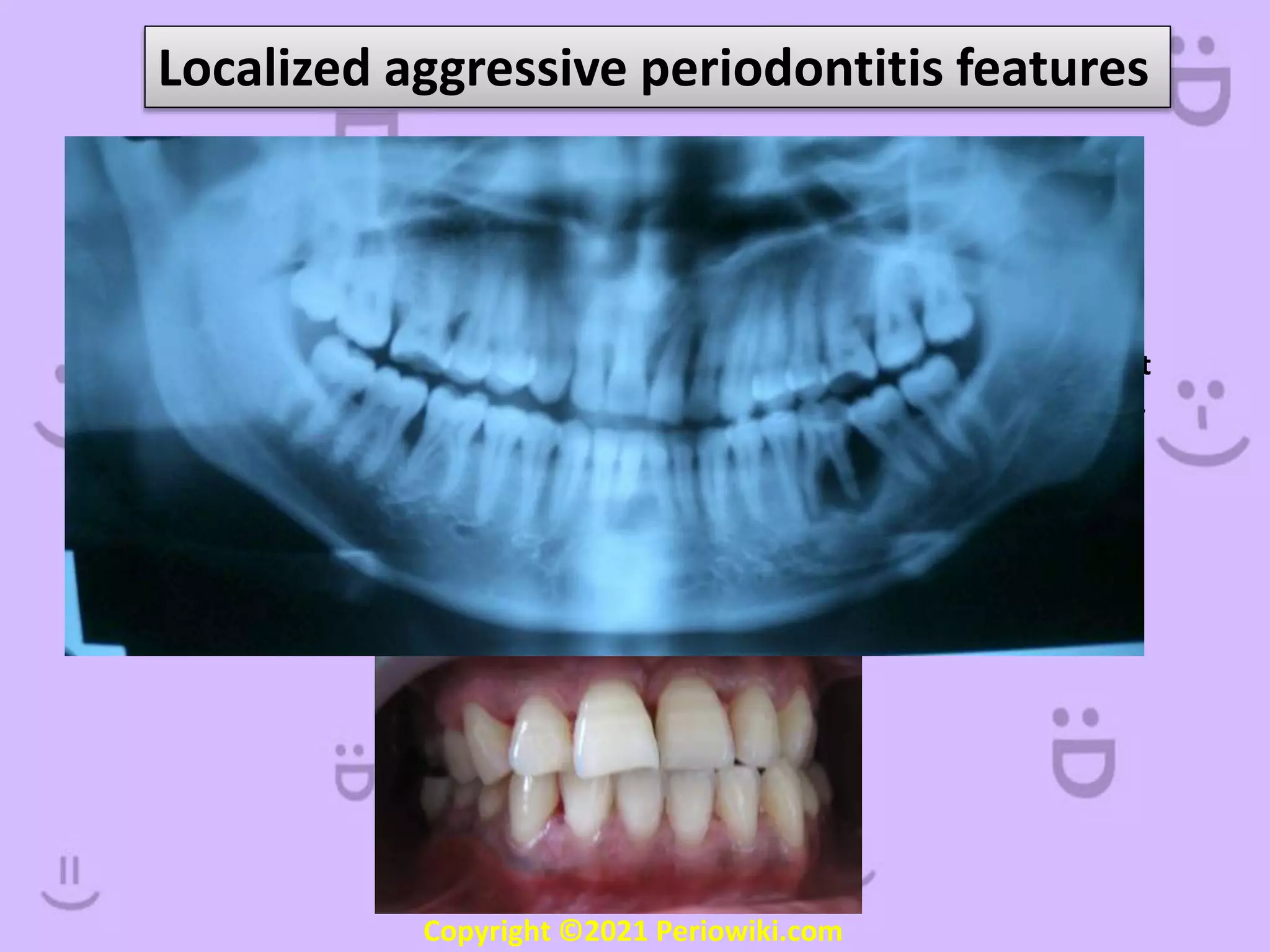 Classification of diseases and conditions affecting the periodontium | PPTX
