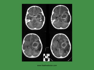 Classification of diseases of cns | PPT