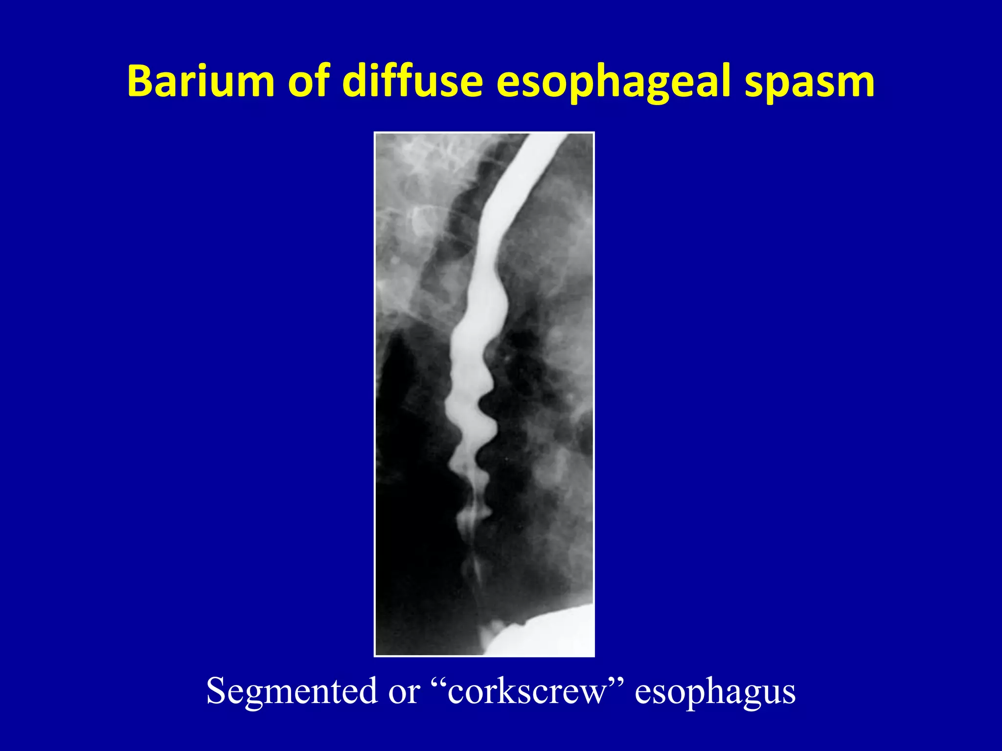 Classification of esophageal motility disorders | PPTX