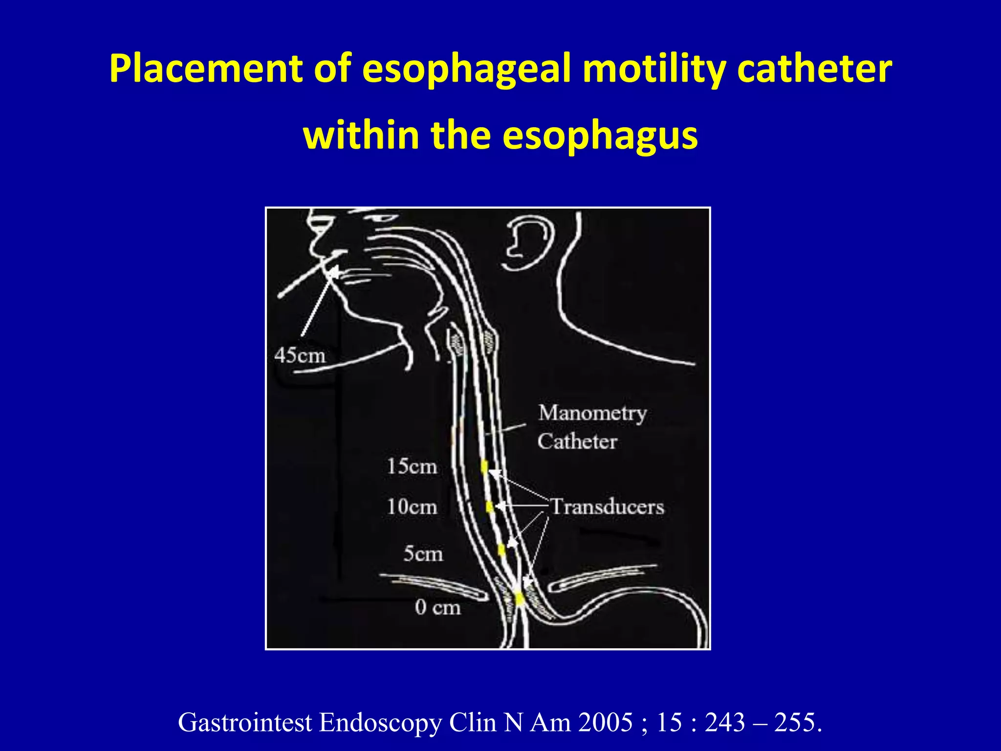 Classification of esophageal motility disorders | PPTX