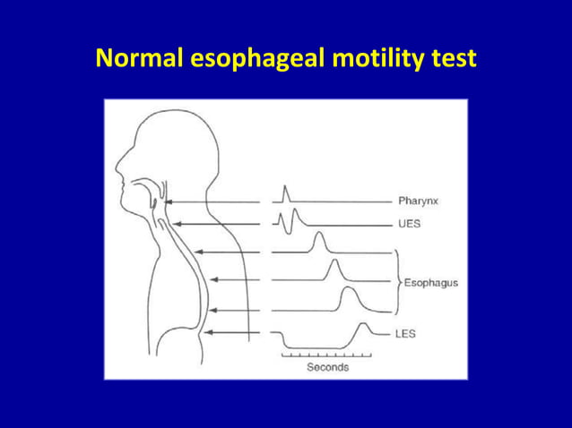 Classification of esophageal motility disorders | PPTX | Digestive ...