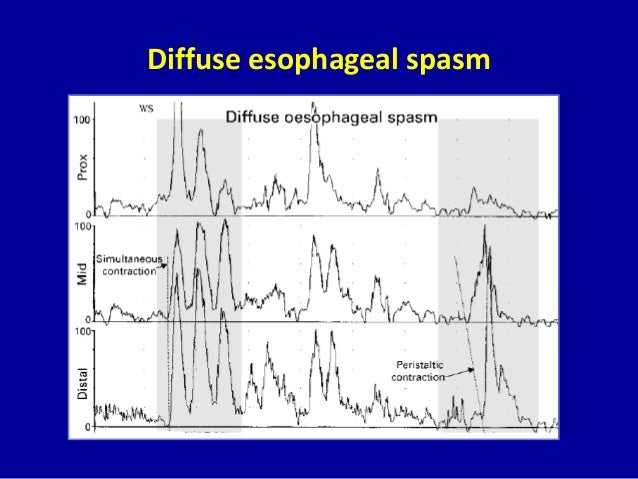 Diffuse Esophageal Spasm Manometry