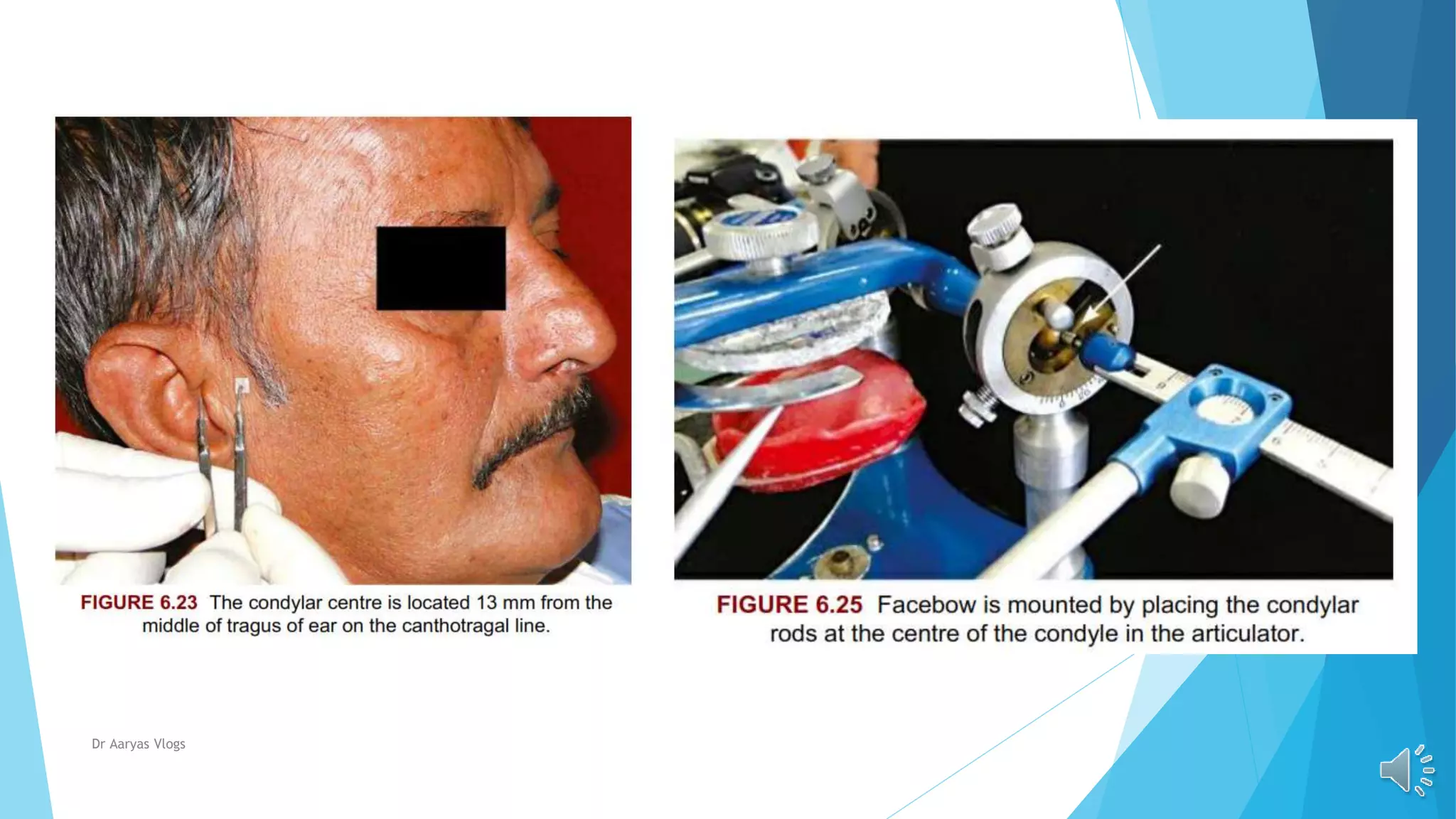Classification of facebow | PPTX
