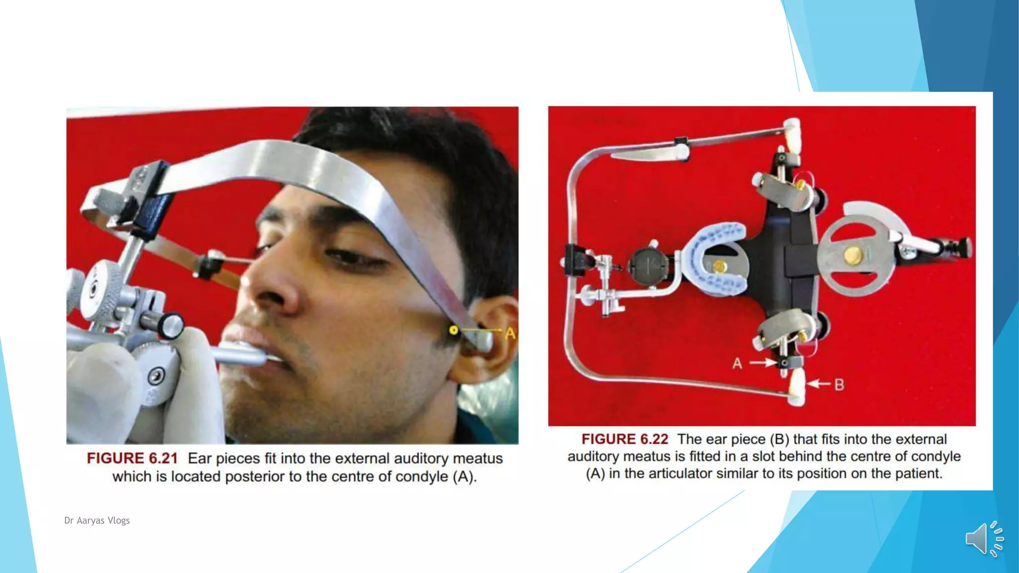 Classification of facebow | PPTX