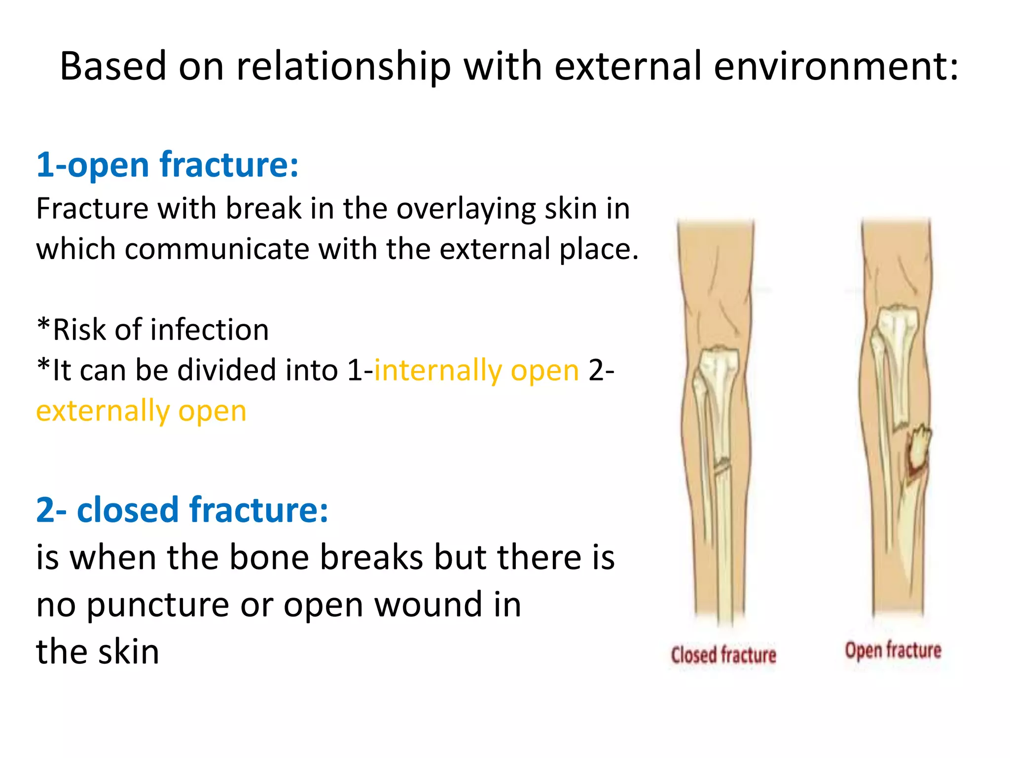Classification of fracture | PPTX