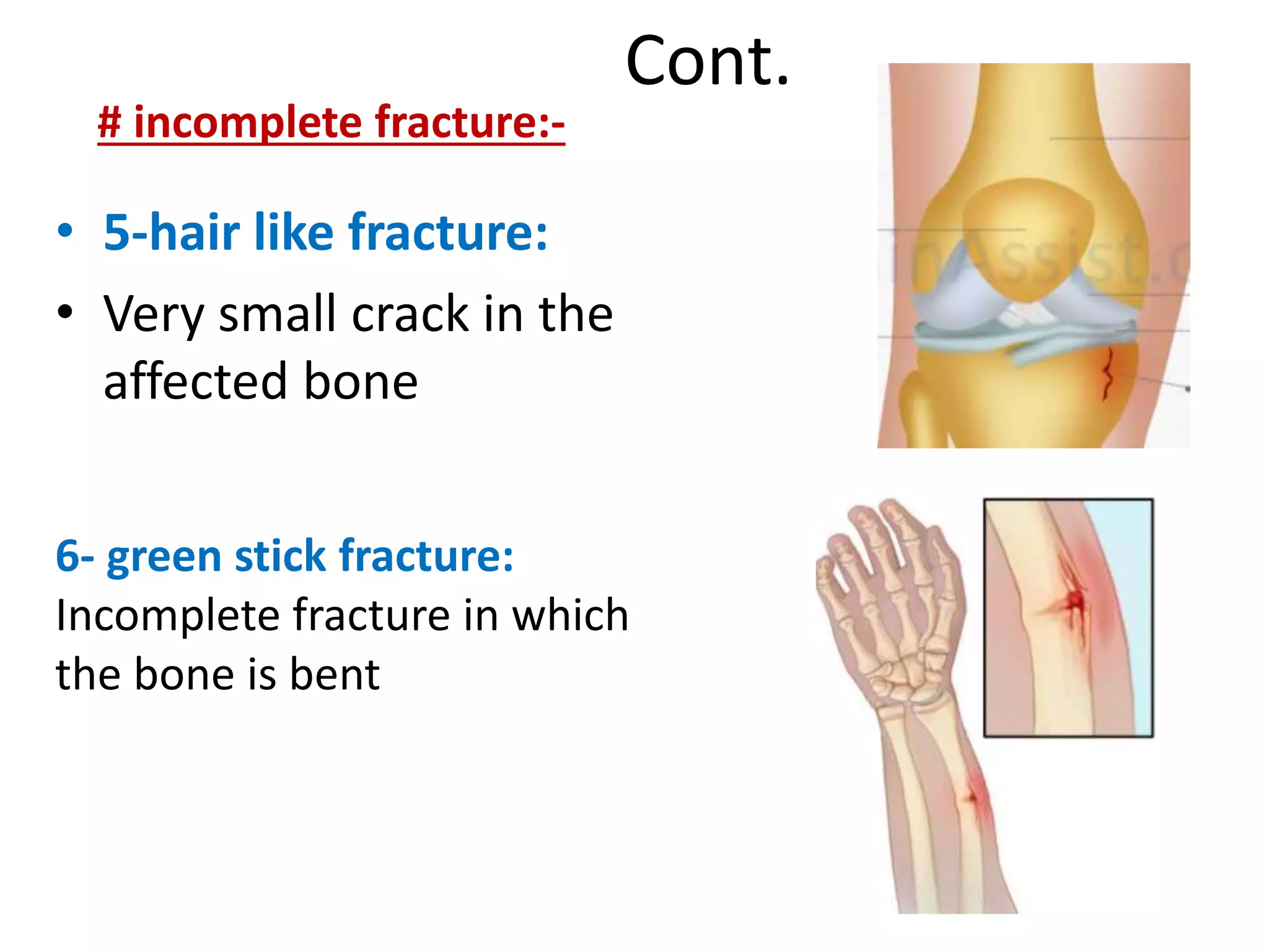 Classification of fracture | PPTX