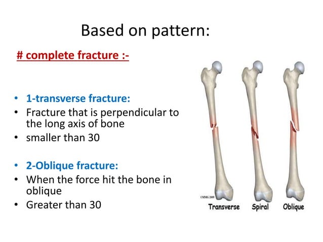 Classification of fracture | PPTX | Death, Injury, or Military Conflict | Sensitive Topics