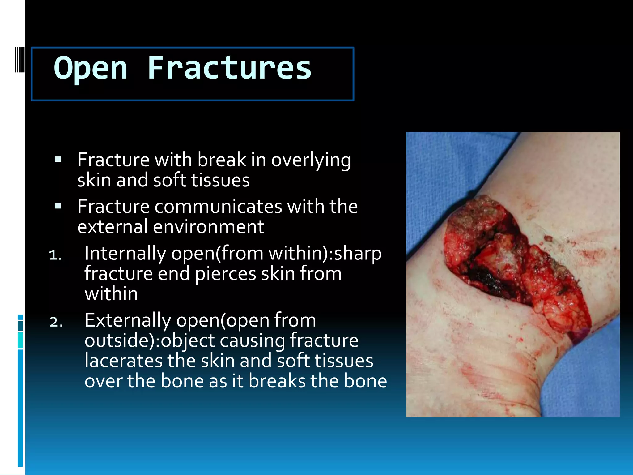 Classification of fractures-2.pptx