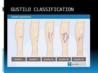 Classification of fractures-2.pptx