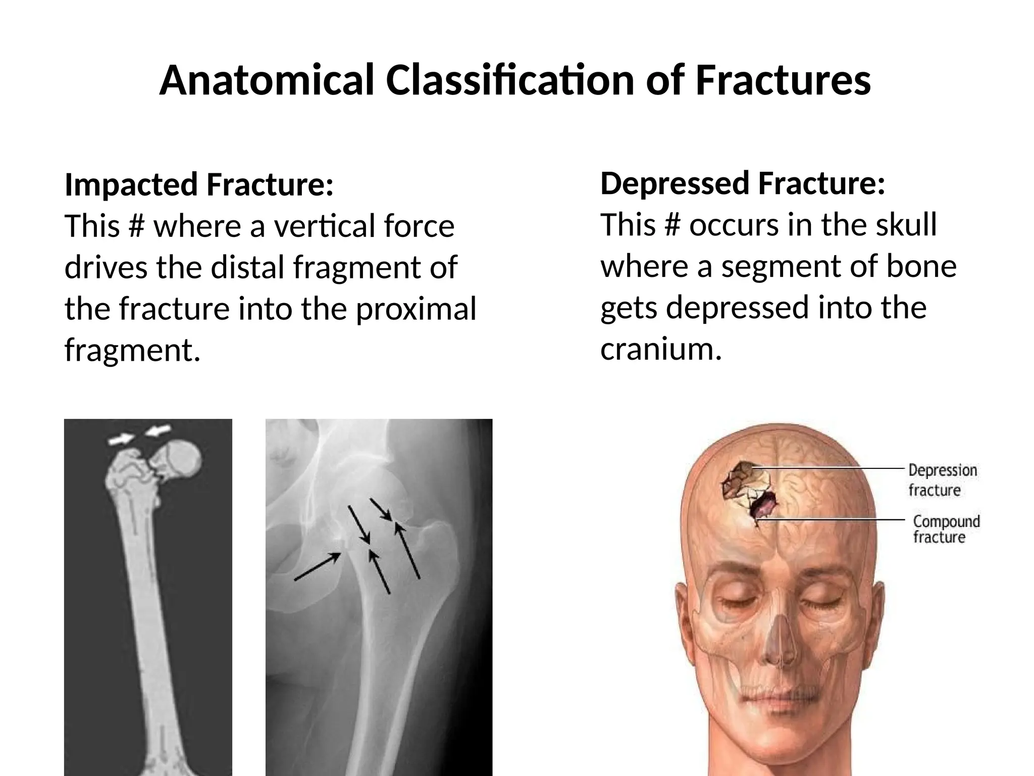 Classification of fractures and fracture healing.pptx