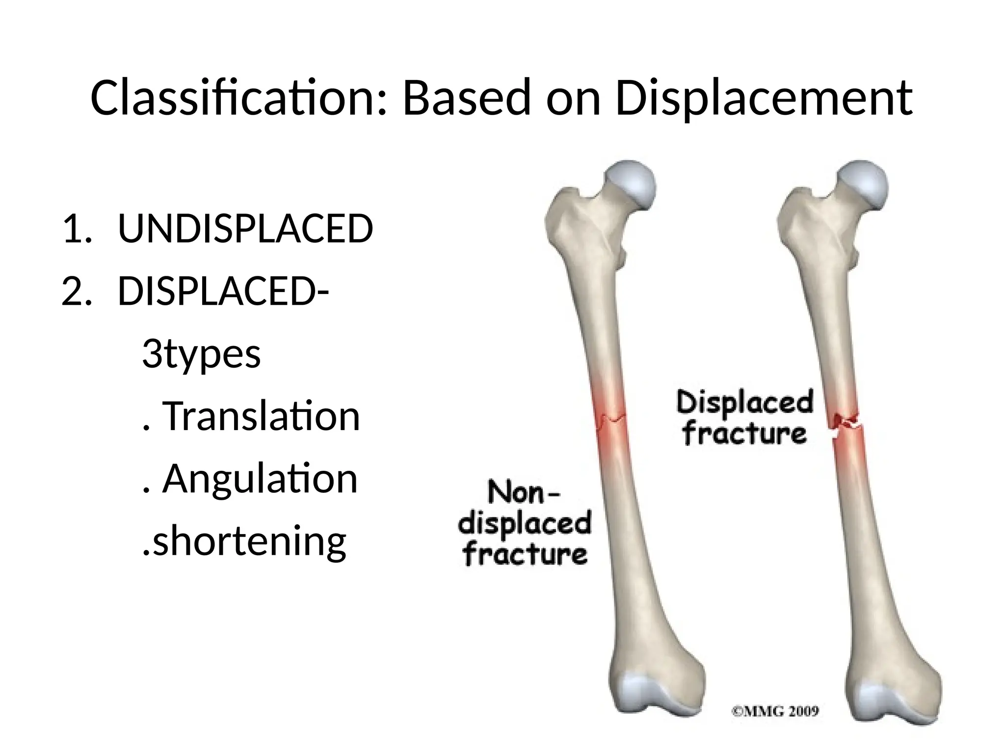 Classification of fractures and fracture healing.pptx