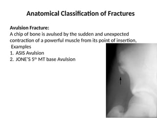 Classification of fractures and fracture healing.pptx