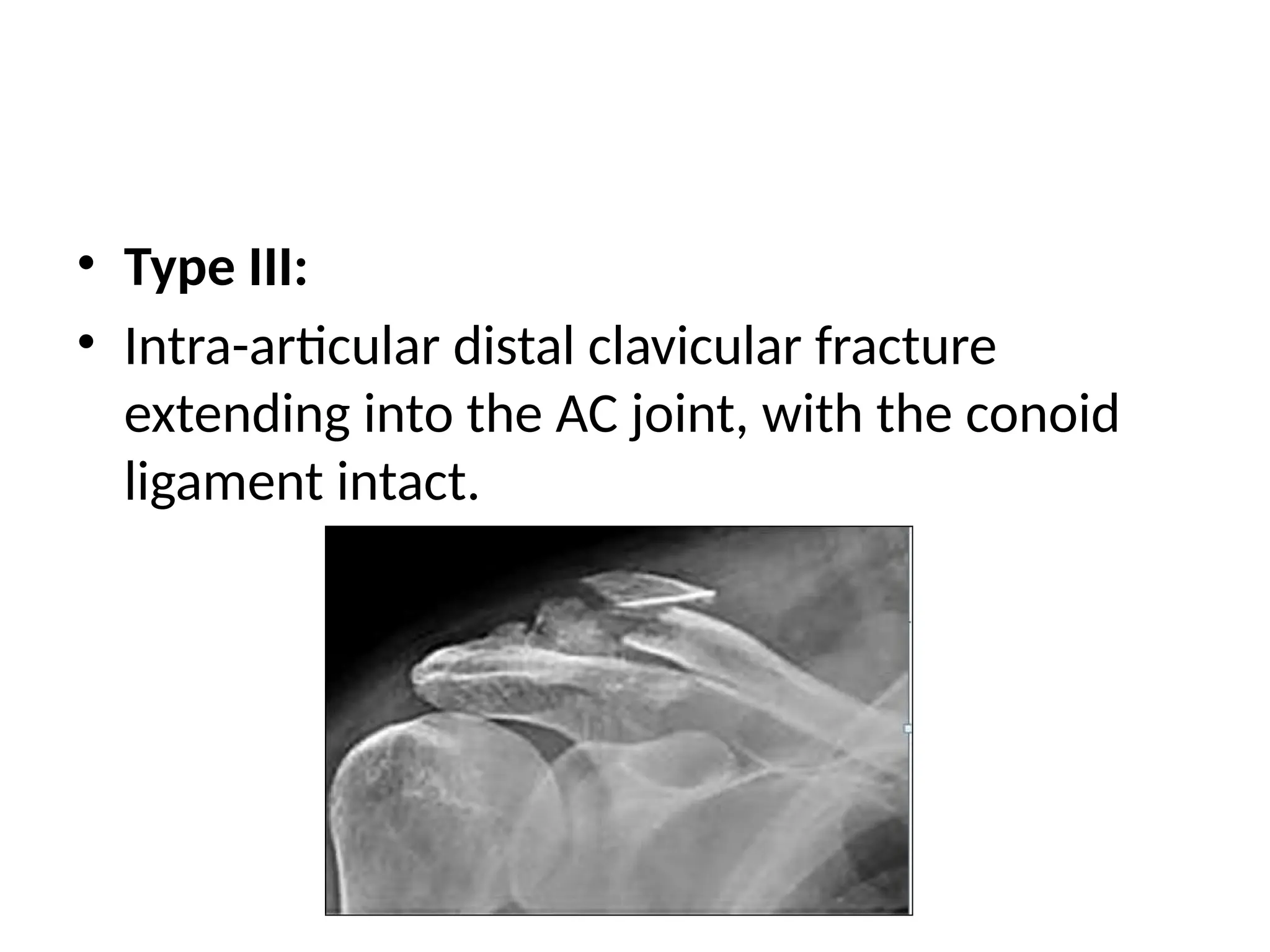 Classification of fractures of lateral end of clavicle.pptx