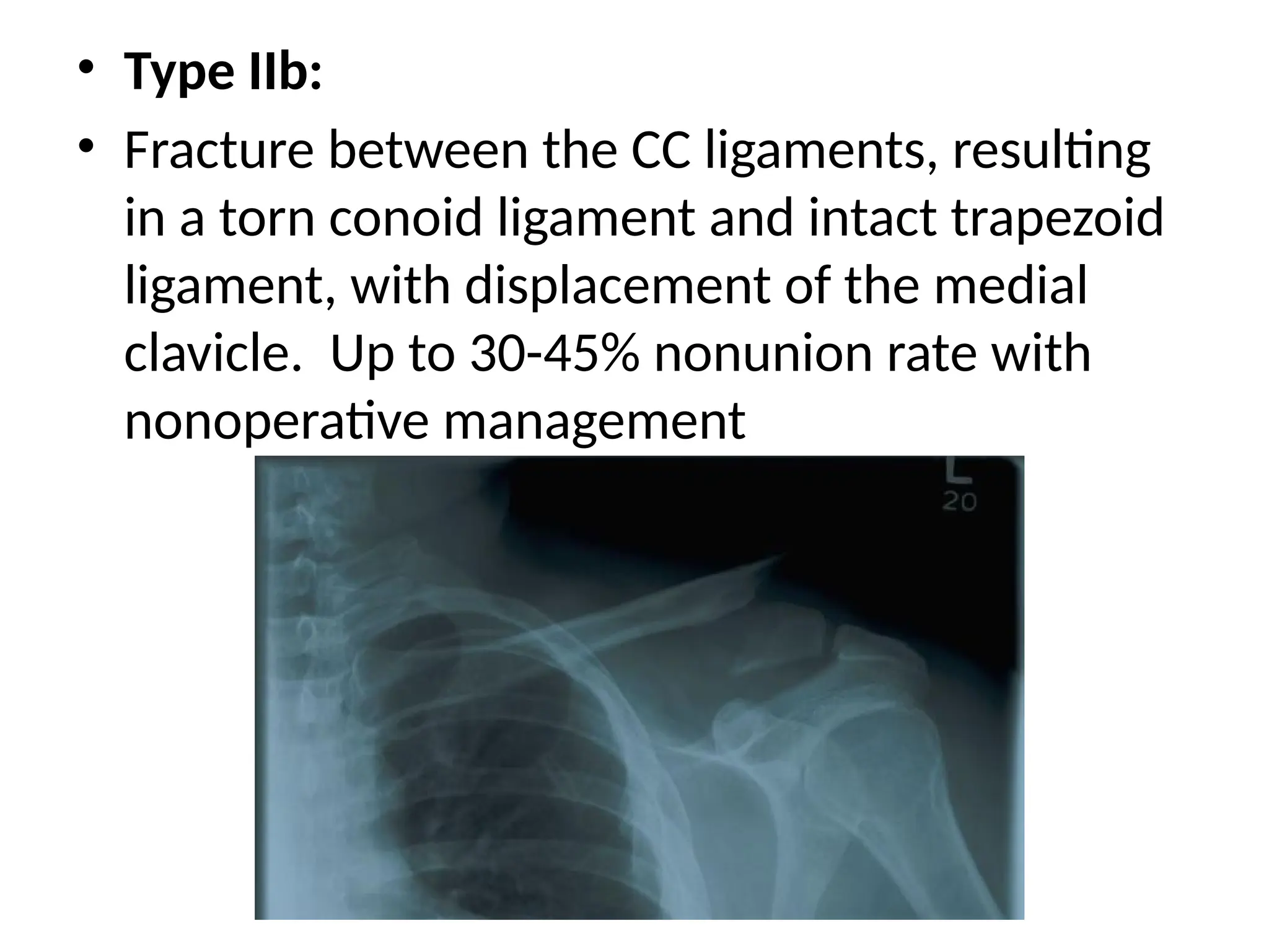 Classification of fractures of lateral end of clavicle.pptx