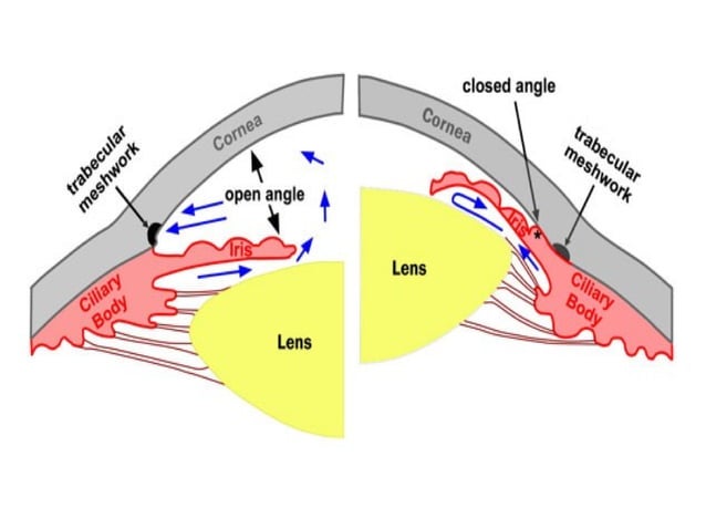 CLASSIFICATION OF GLAUCOMA (including Paediatric Glaucoma).pptx