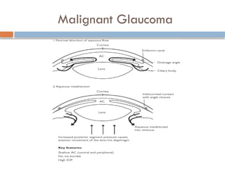 CLASSIFICATION OF GLAUCOMA (including Paediatric Glaucoma).pptx