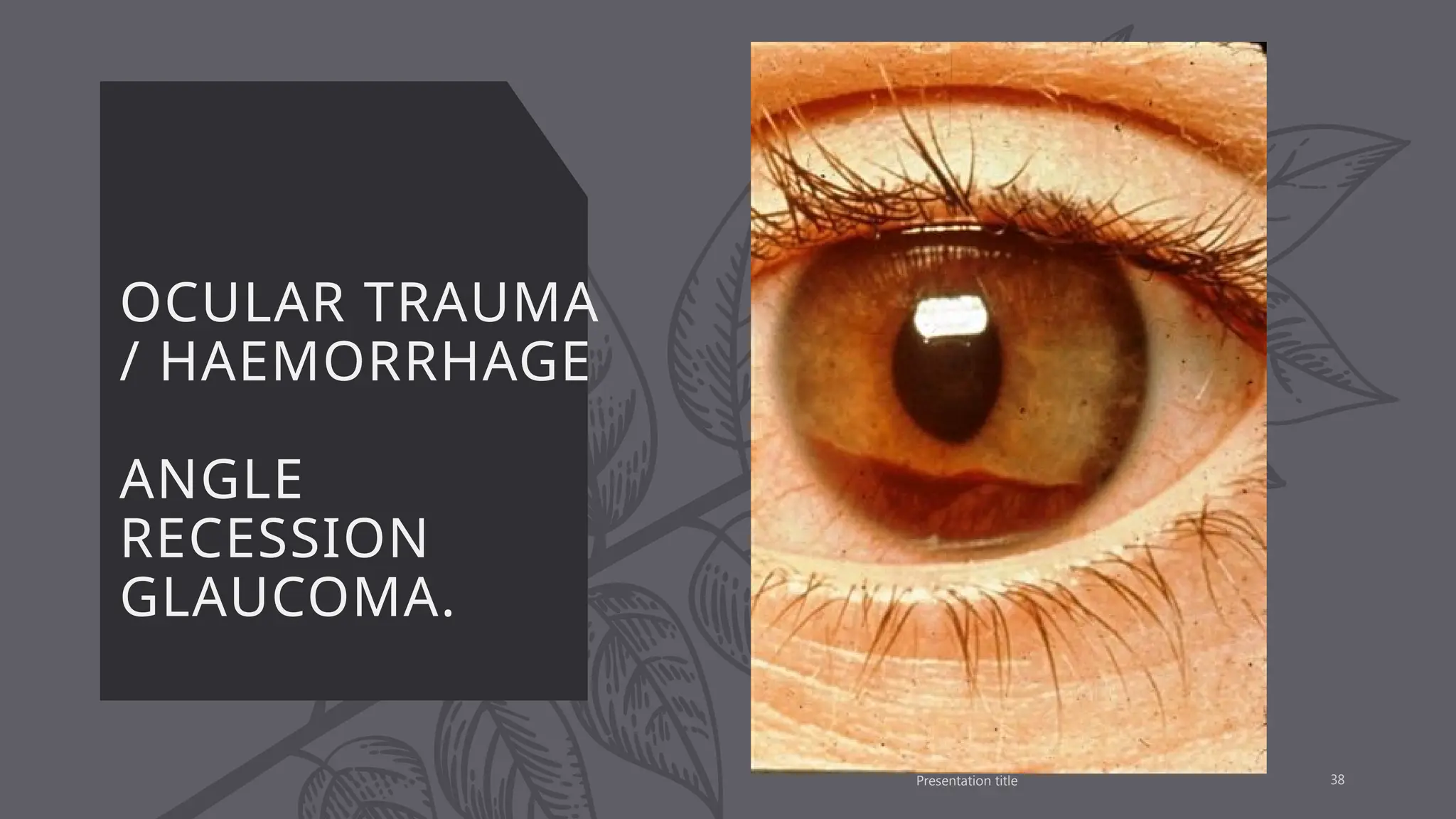 General Classification Of GLAUCOMA..pptx