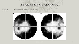 General Classification Of GLAUCOMA..pptx