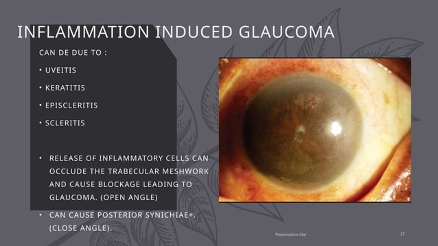 General Classification Of GLAUCOMA..pptx