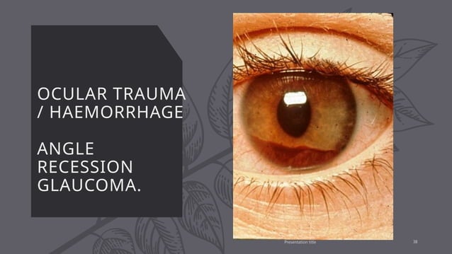 General Classification Of GLAUCOMA..pptx