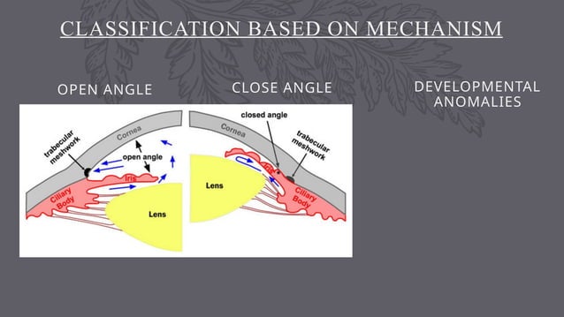 General Classification Of GLAUCOMA..pptx