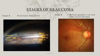 General Classification Of GLAUCOMA..pptx