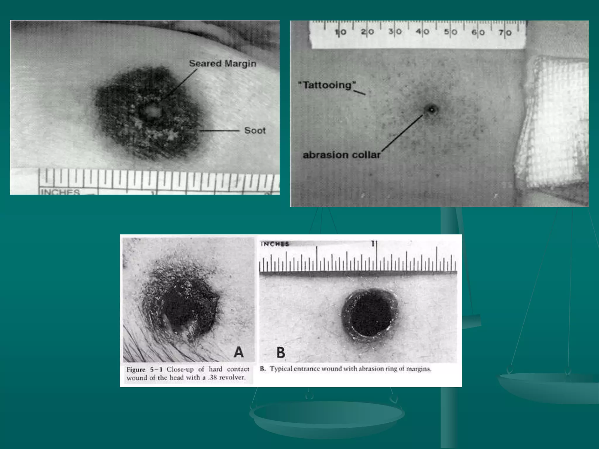 Classification of gunshot wounds | PPTX
