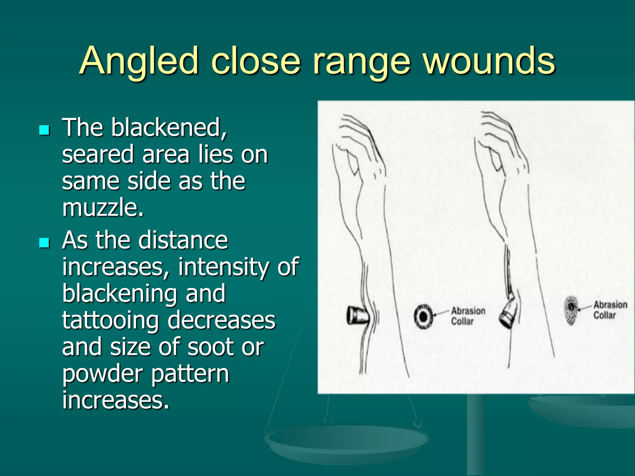Classification of gunshot wounds | PPTX