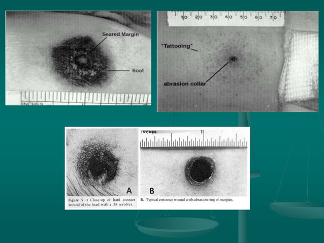 Classification of gunshot wounds | PPTX